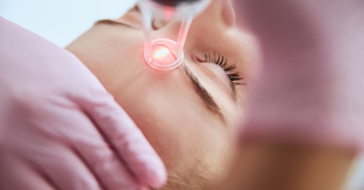 Frax CO2-Laser - Derma & Ästhetik